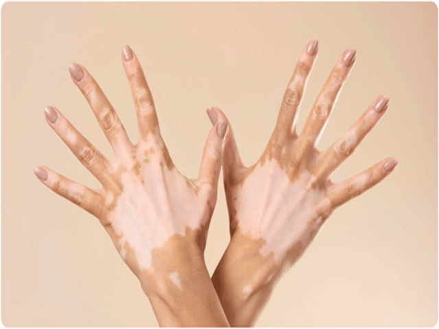 Vitiligo: Have white patches appeared on your face or hands? Does the ...